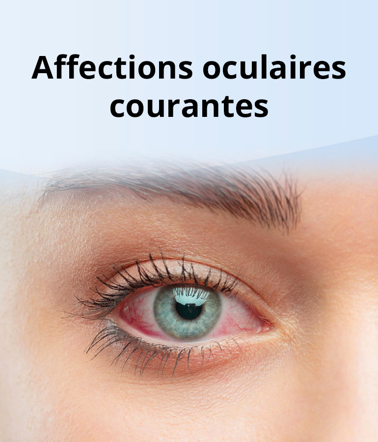 Affections oculaires courantes - Oscar Wylee Canada
