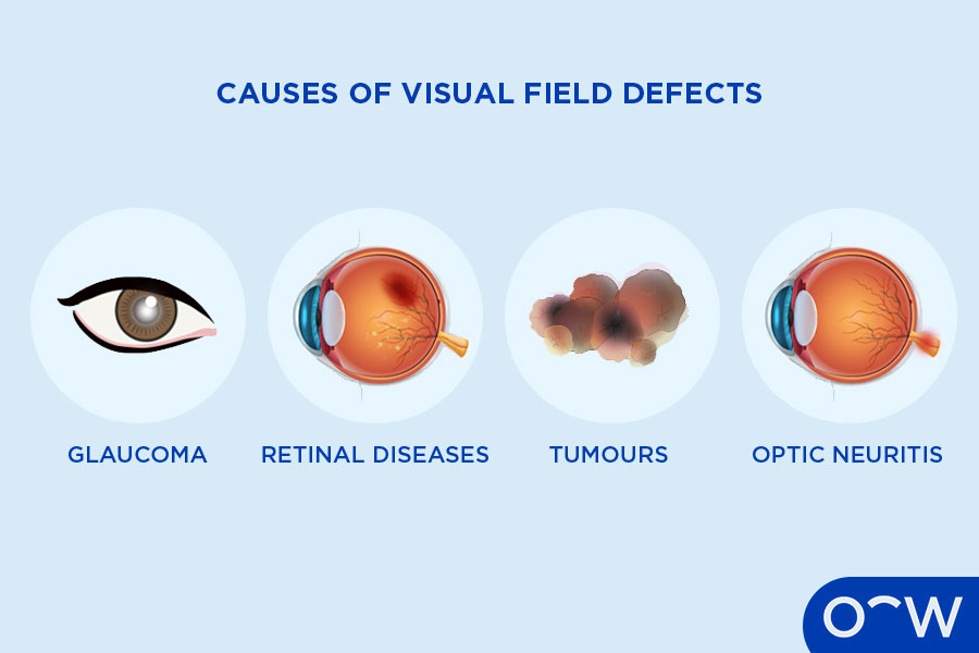 Visual Field Test: How Does it Work, Types and Benefits