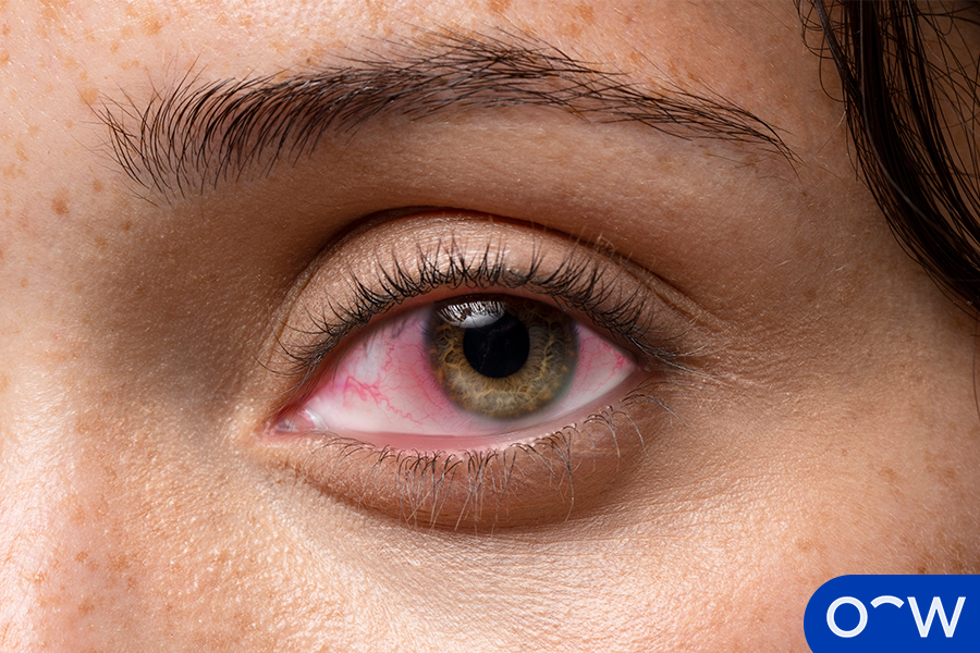 Allergies oculaires : Types, causes, symptômes et traitements