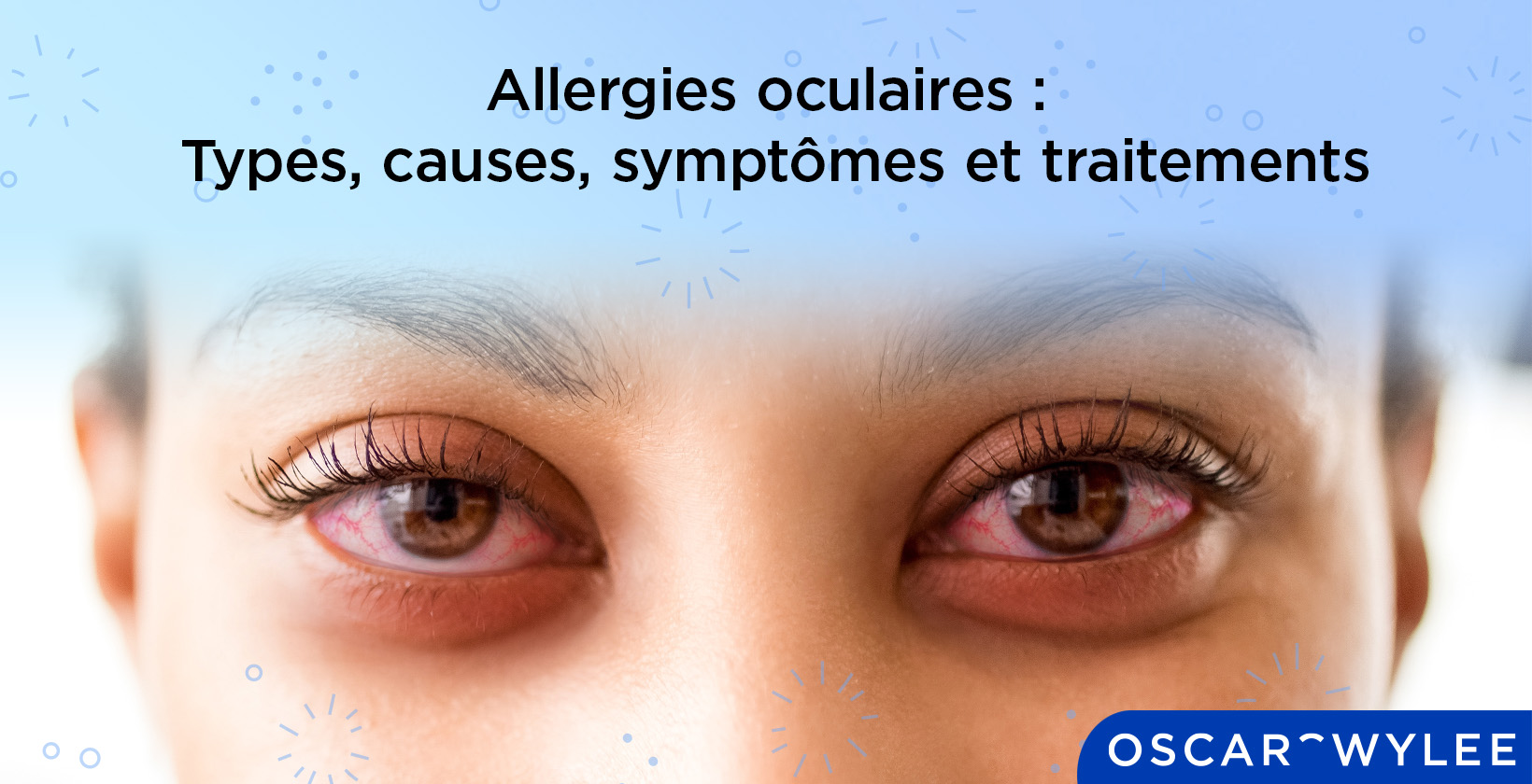 Allergies oculaires : Types, causes, symptômes et traitements