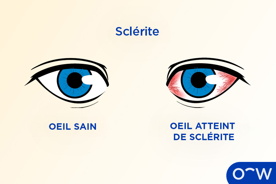 La sclère : anatomie, fonction et problèmes oculaires liés