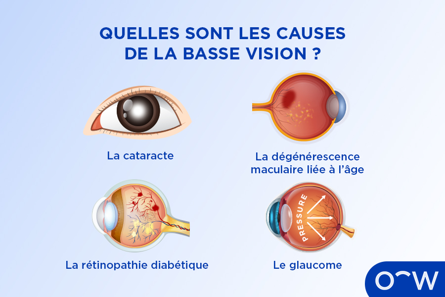 La basse vision : quels sont les causes d’une mauvaise vision