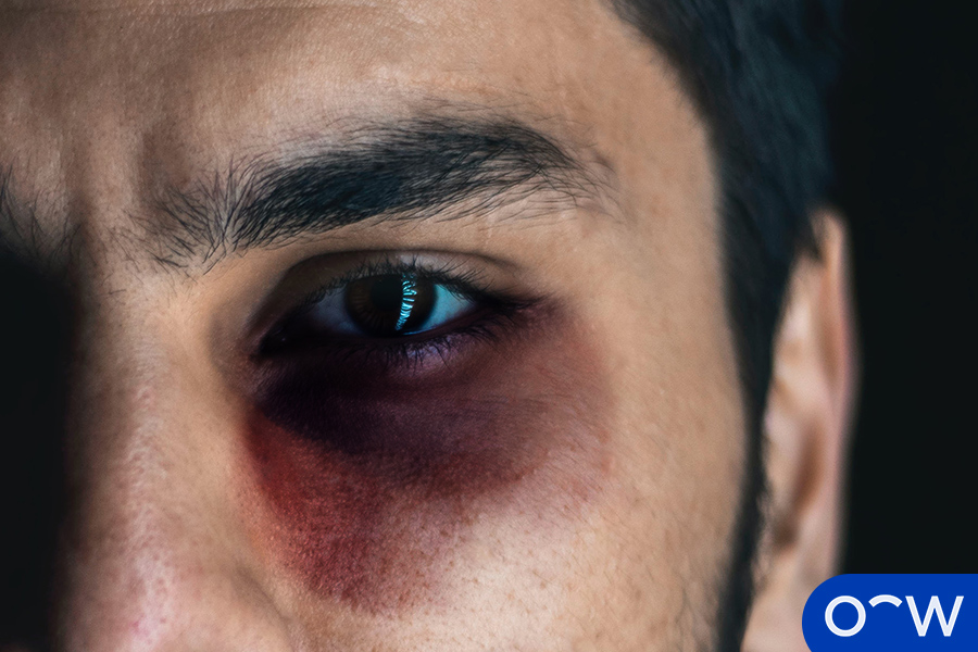 L’œil au beurre noir (hématome périorbitaire) : causes, symptômes, facteurs de risque et traitement