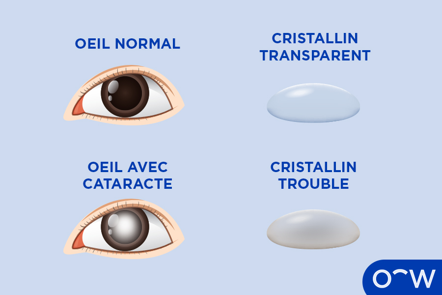 La cataracte : définition, types, causes, symptômes, traitement, et ...