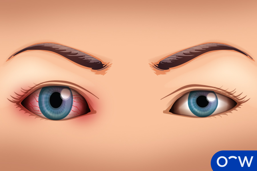 La conjonctivite (œil rose) : symptômes, causes et traitement