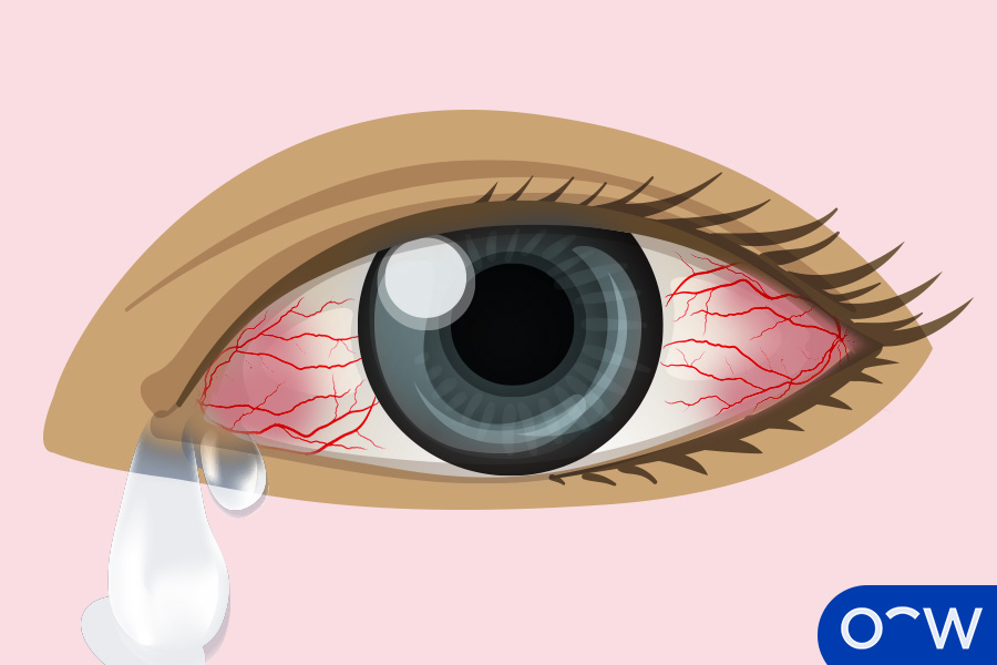 La conjonctivite (œil rose) : symptômes, causes et traitement