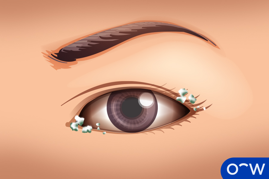 La conjonctivite (œil rose) : symptômes, causes et traitement