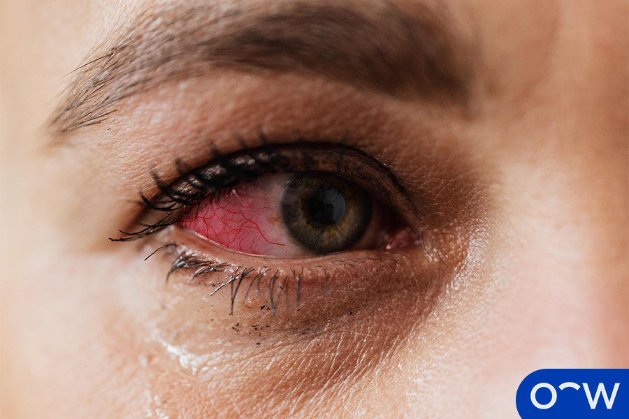 La conjonctivite (œil rose) : symptômes, causes et traitement