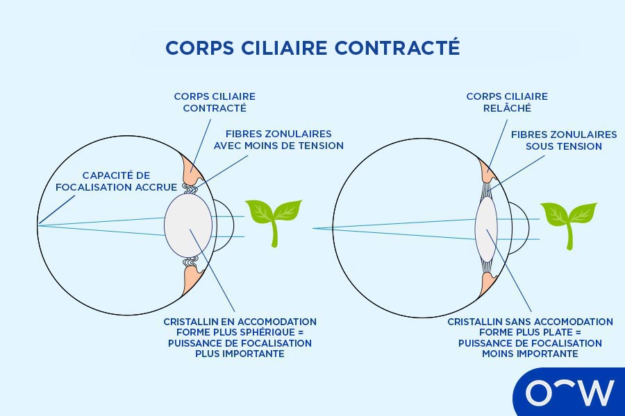 Le corps ciliaire : anatomie, fonction et maladies oculaires liées