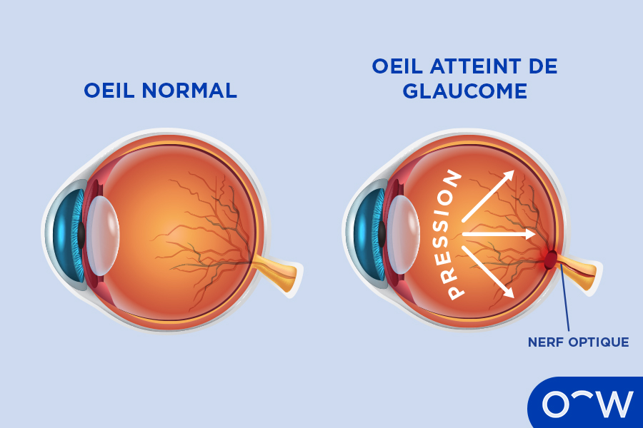 Le glaucome : définition, symptômes, types, causes, diagnostic et ...