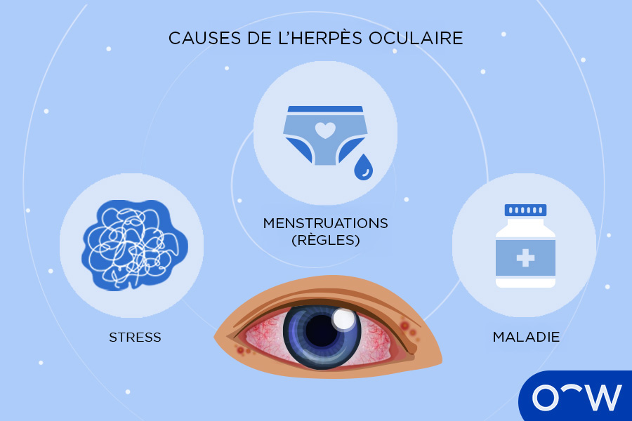 L’herpès oculaire : causes, symptômes, facteurs de risque et traitement