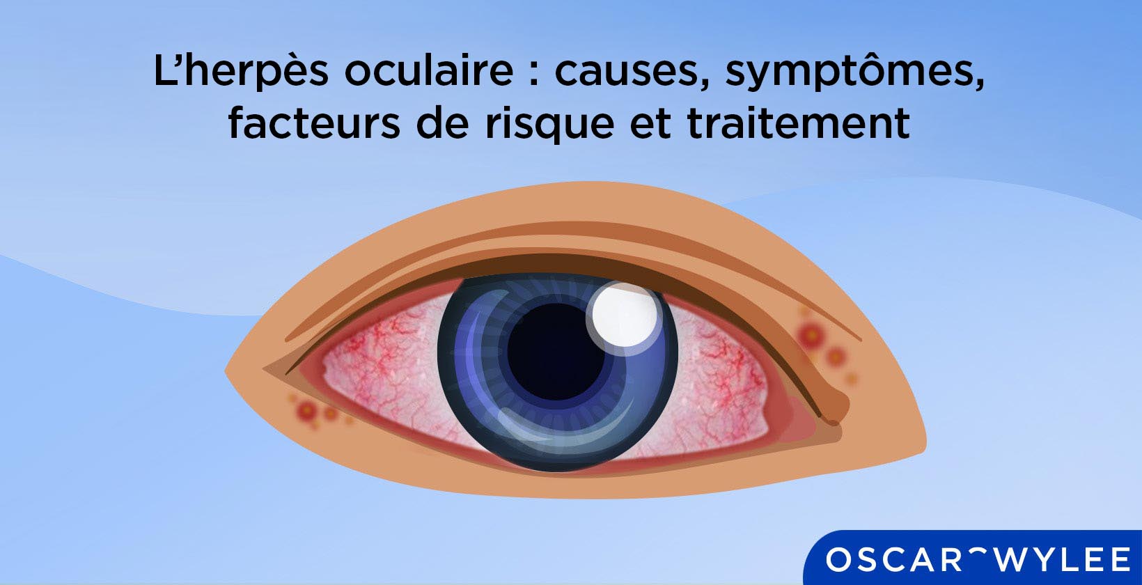L’herpès oculaire : causes, symptômes, facteurs de risque et traitement