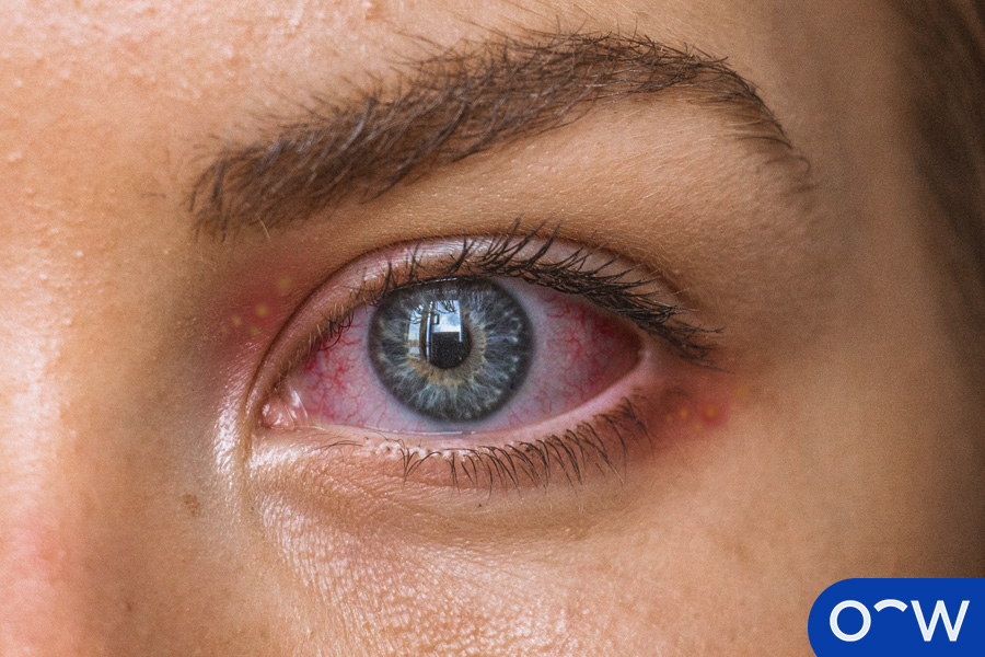 L’herpès oculaire : causes, symptômes, facteurs de risque et traitement