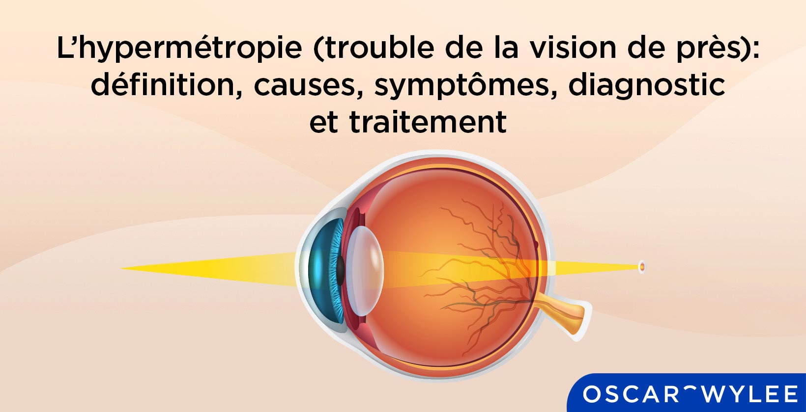 L’hypermétropie (trouble de la vision de près): définition, causes ...
