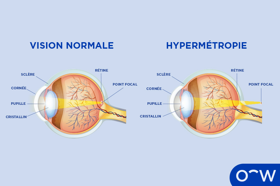 L’hypermétropie (trouble de la vision de près): définition, causes ...
