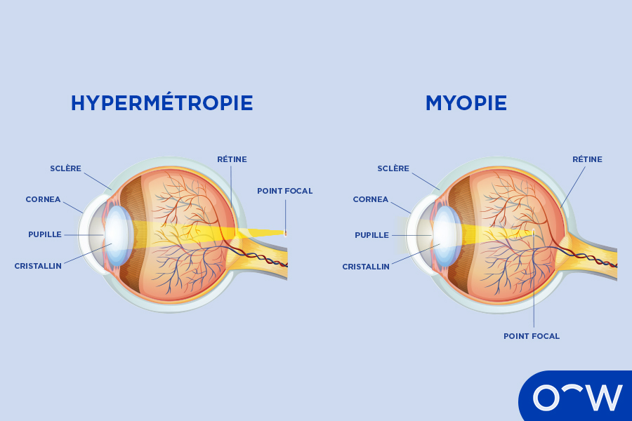 L’hypermétropie (trouble de la vision de près): définition, causes ...