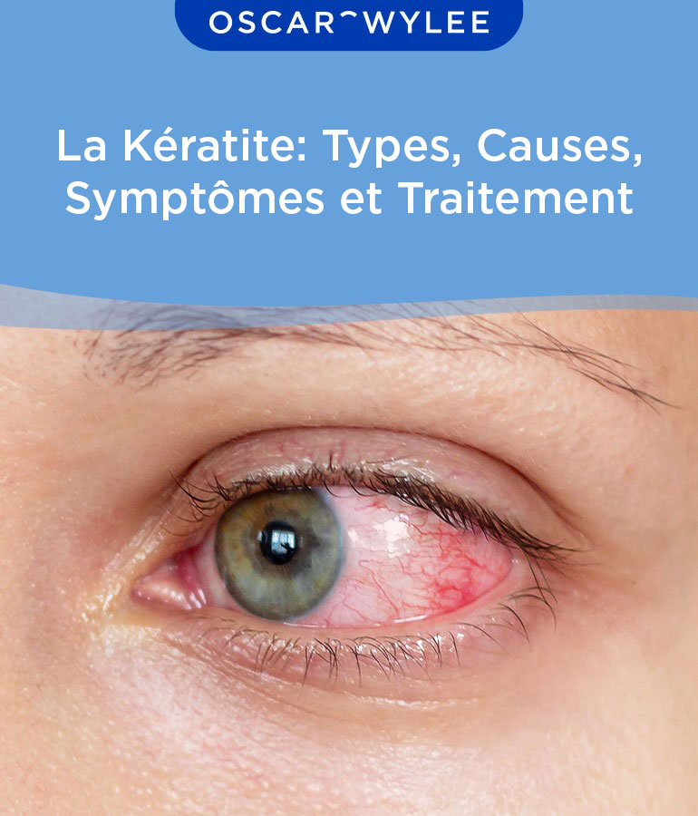 La kératite : types, causes, symptômes et traitement
