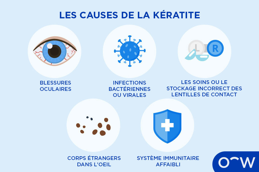 La kératite : types, causes, symptômes et traitement