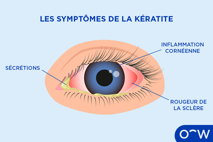 La kératite : types, causes, symptômes et traitement