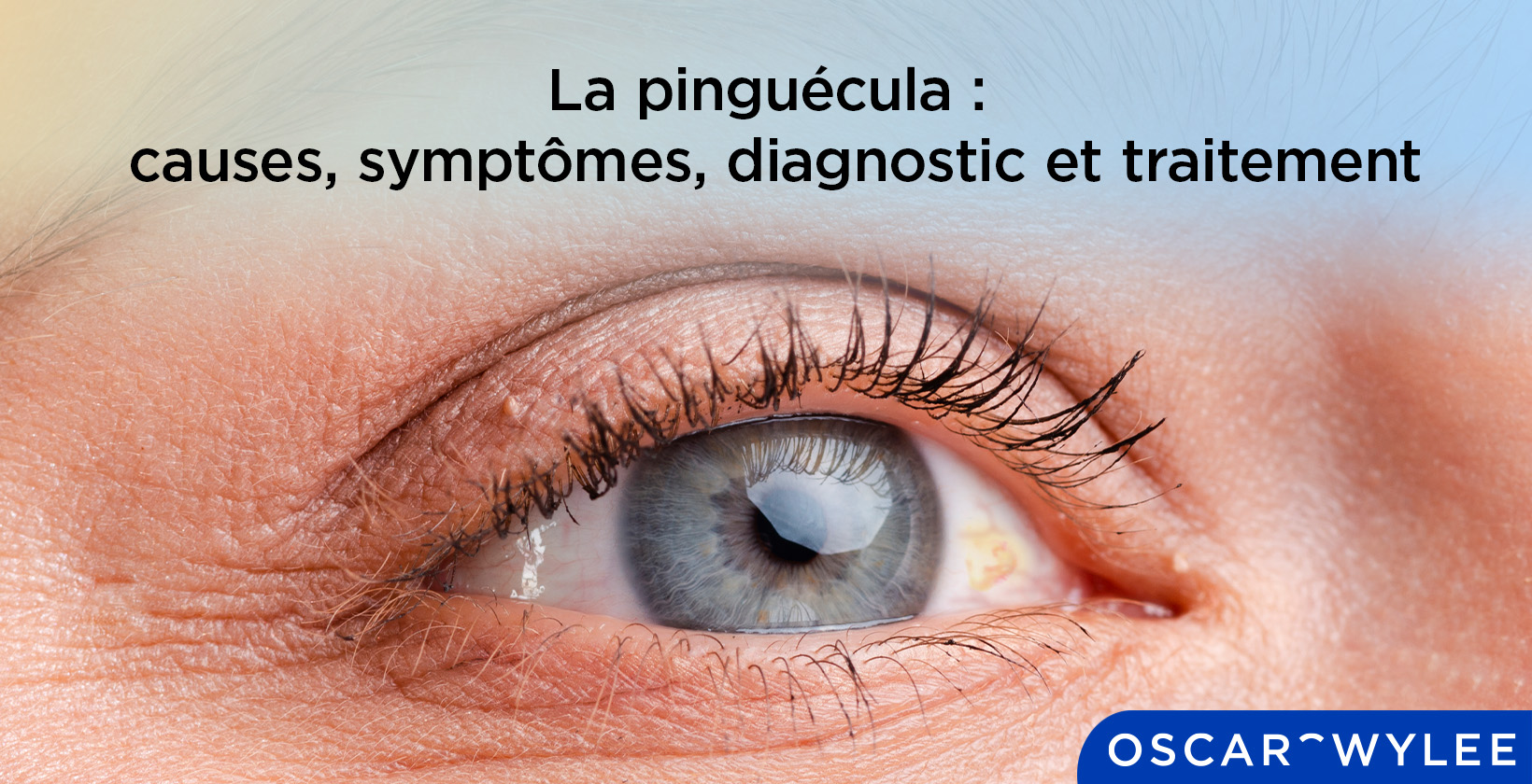 La pinguécula : causes, symptômes, diagnostic et traitement