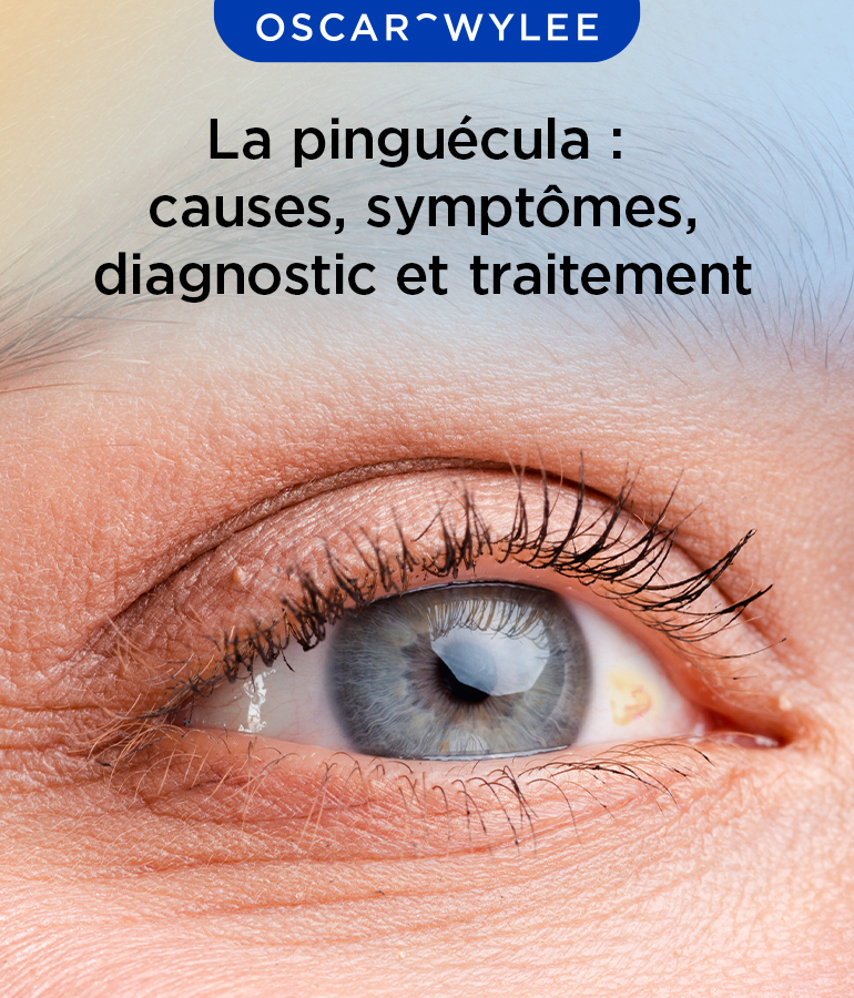 La pinguécula : causes, symptômes, diagnostic et traitement