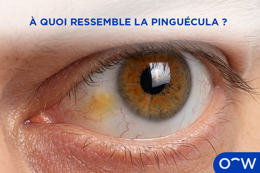 La pinguécula : causes, symptômes, diagnostic et traitement