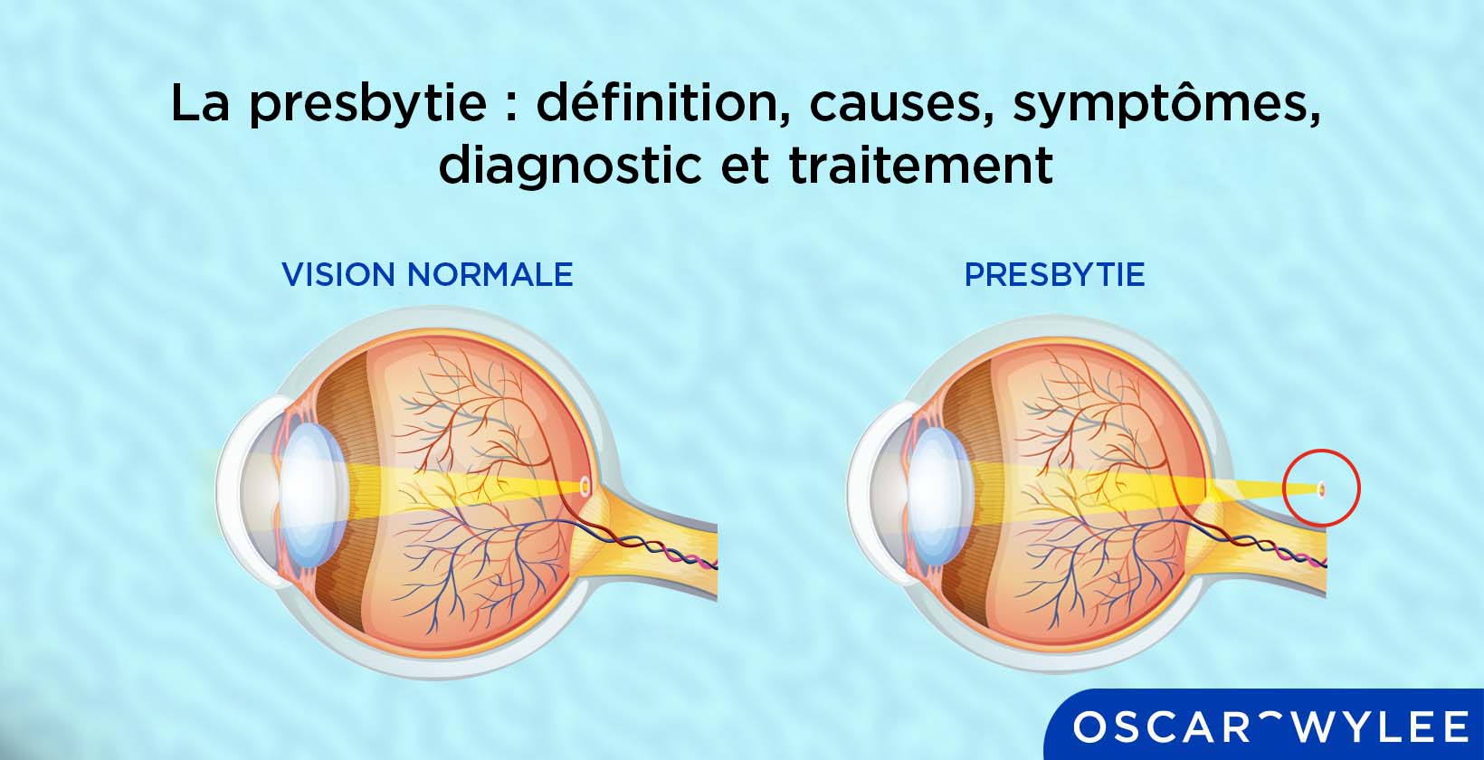 La presbytie : définition, causes, symptômes, diagnostic et traitement
