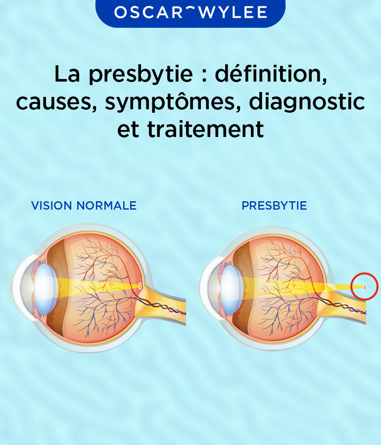 La presbytie : définition, causes, symptômes, diagnostic et traitement