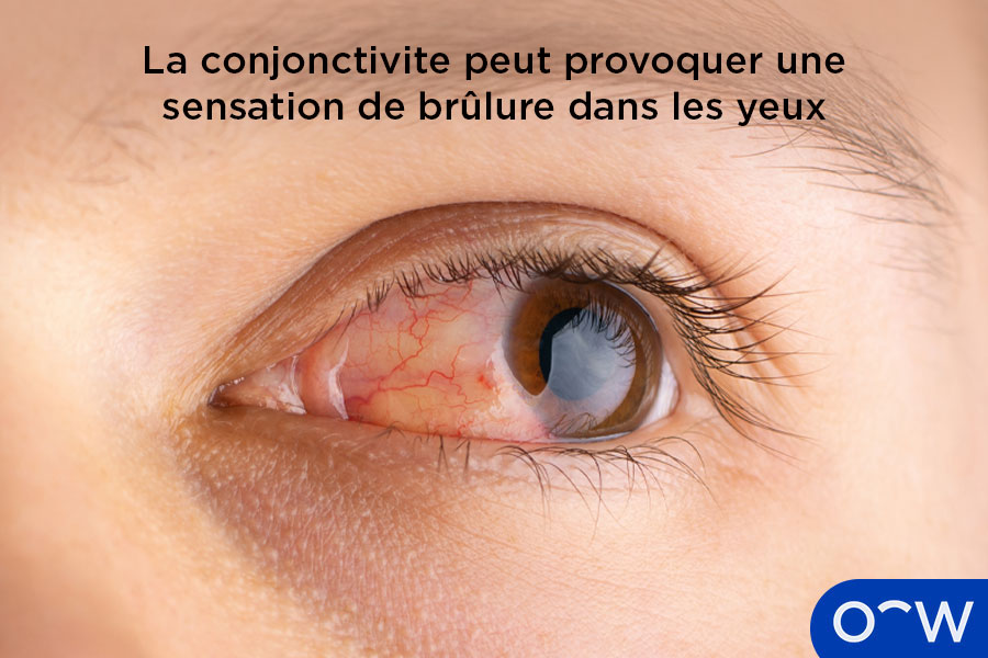 Que faire en cas de brûlure oculaire : mesures immédiates et traitement