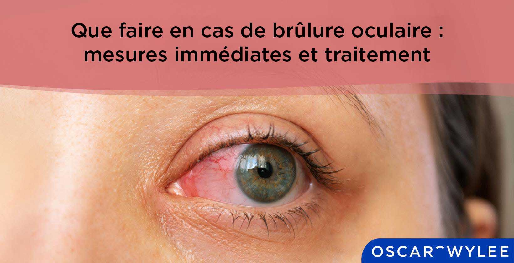 Que faire en cas de brûlure oculaire : mesures immédiates et traitement