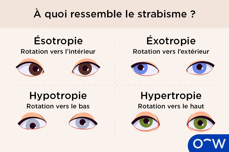 4 exercices oculaires pour le strabisme