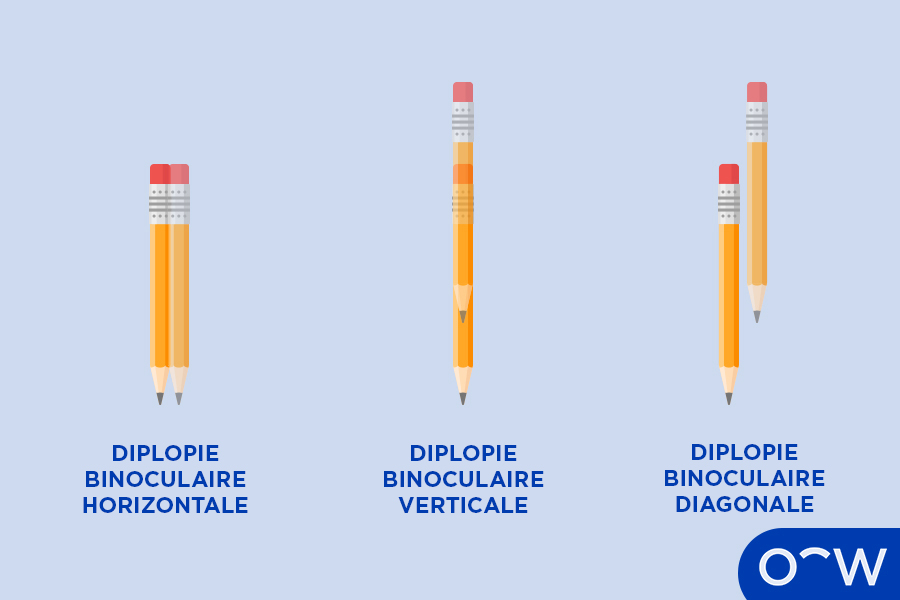 Vision double (diplopie) : Définition, types, causes, symptômes ...