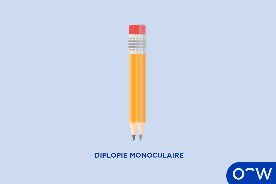Vision double (diplopie) : Définition, types, causes, symptômes ...