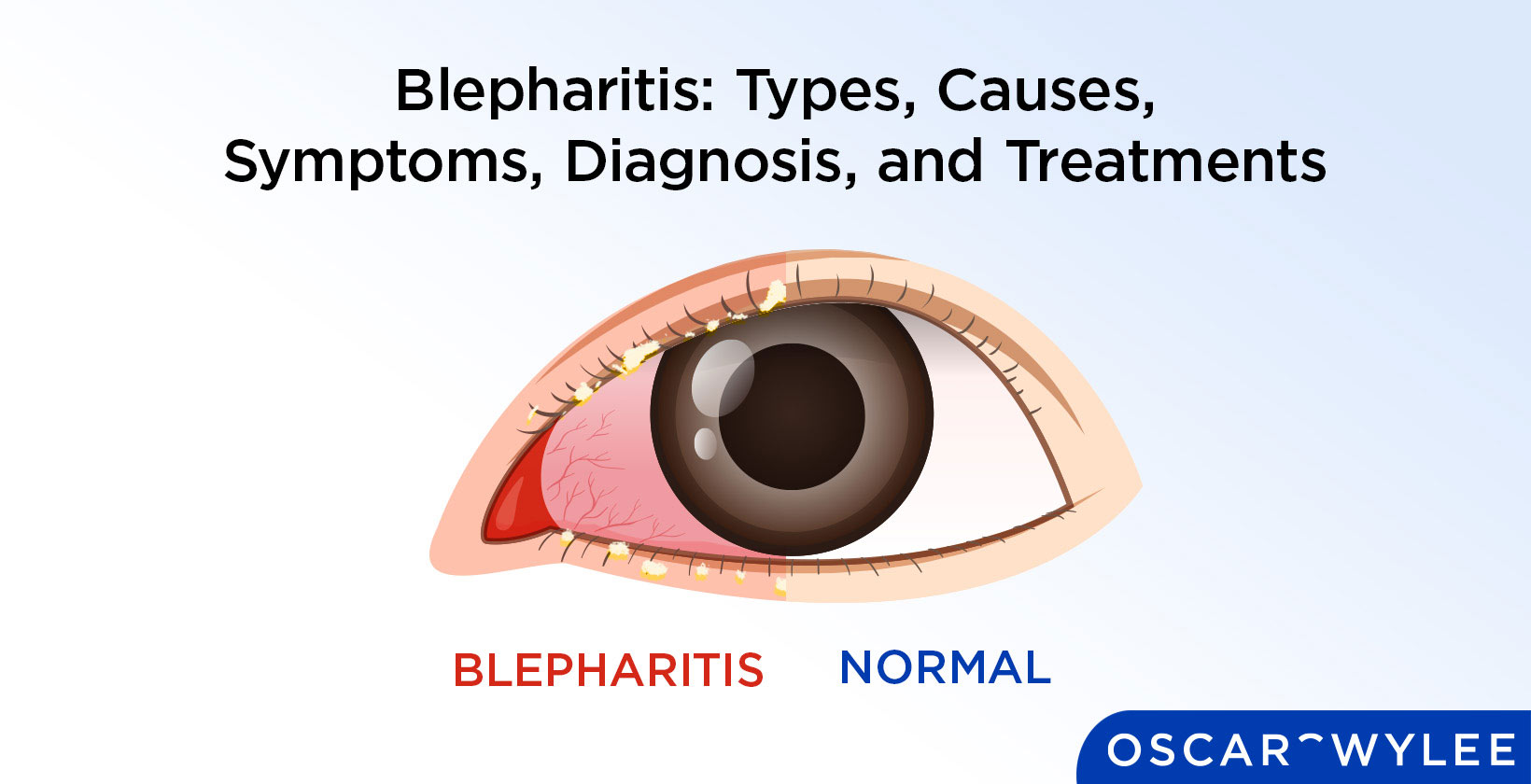 Blepharitis: Types, Causes, Symptoms, Diagnosis, and Treatments