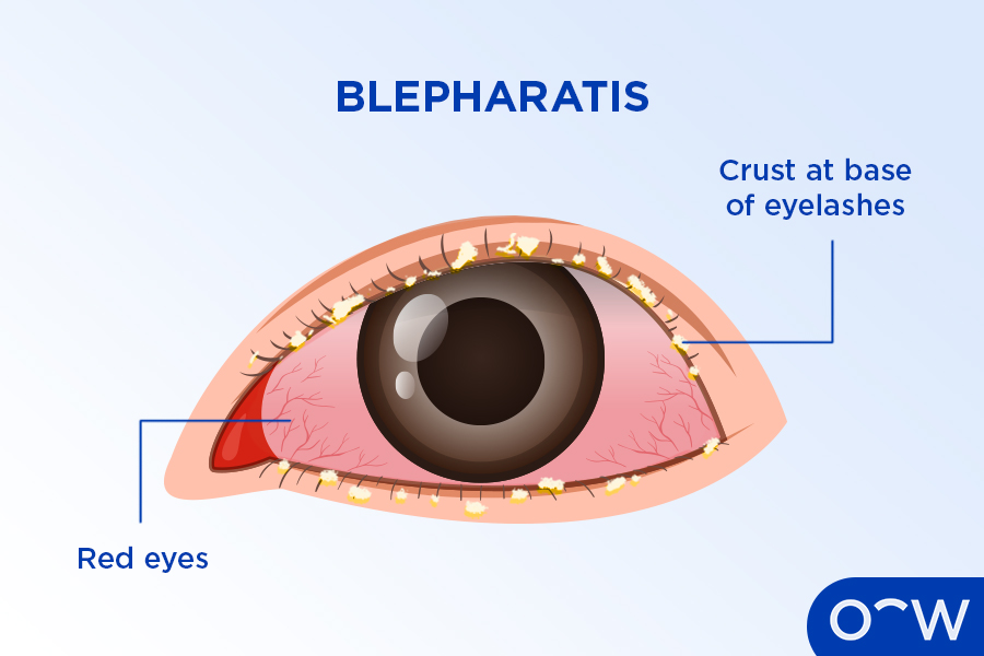 Blepharitis: Types, Causes, Symptoms, Diagnosis, and Treatments