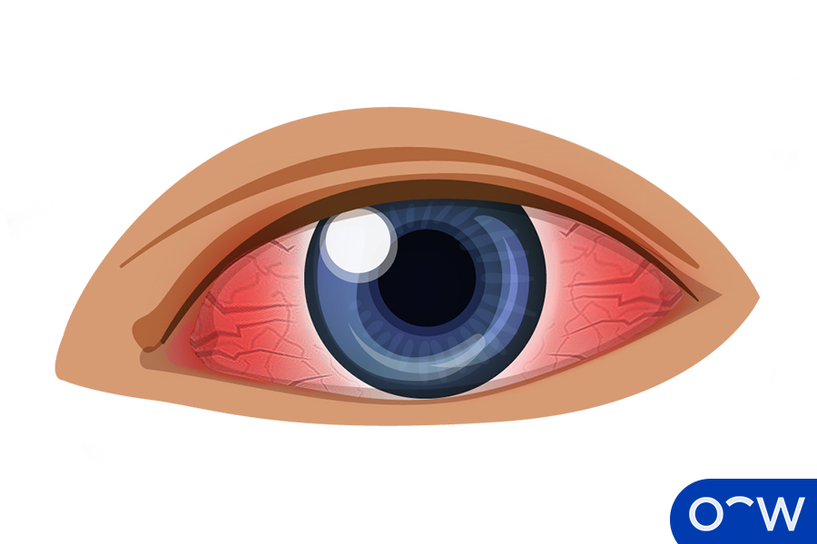 Eye Allergies: Types, Causes, Symptoms, and Treatments