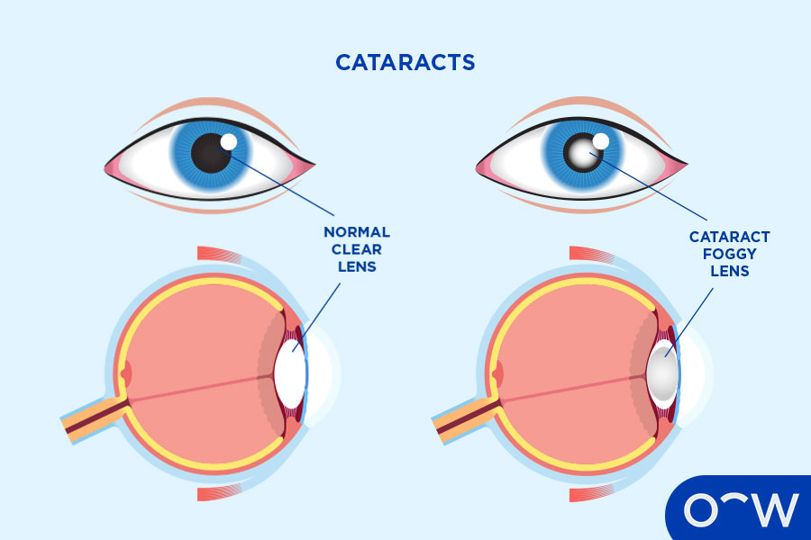Pupil: Anatomy, Function, and Related Eye Conditions