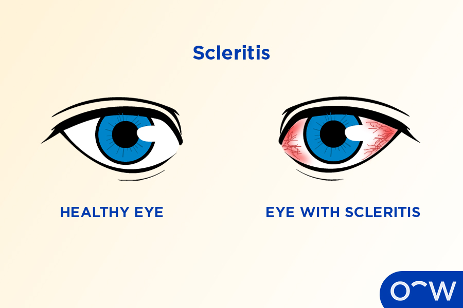 Sclera: Anatomy, Function, and Related Eye Problems