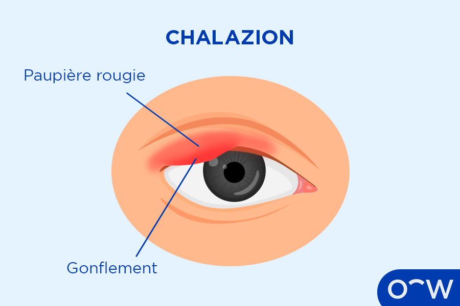 Chalazion : Symptômes, causes, diagnostic et traitements