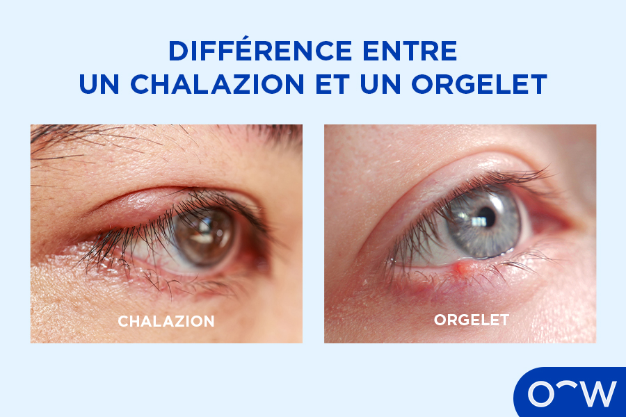 Chalazion : Symptômes, causes, diagnostic et traitements