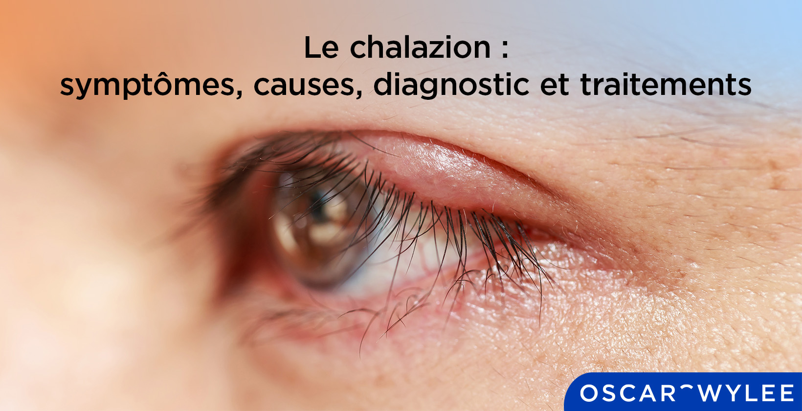 Chalazion : Symptômes, causes, diagnostic et traitements