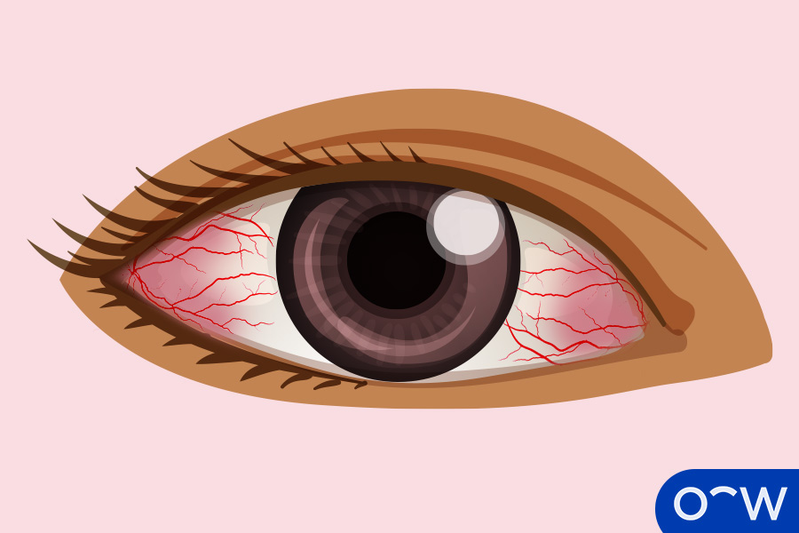 Can Swelling Cause Pink Eye