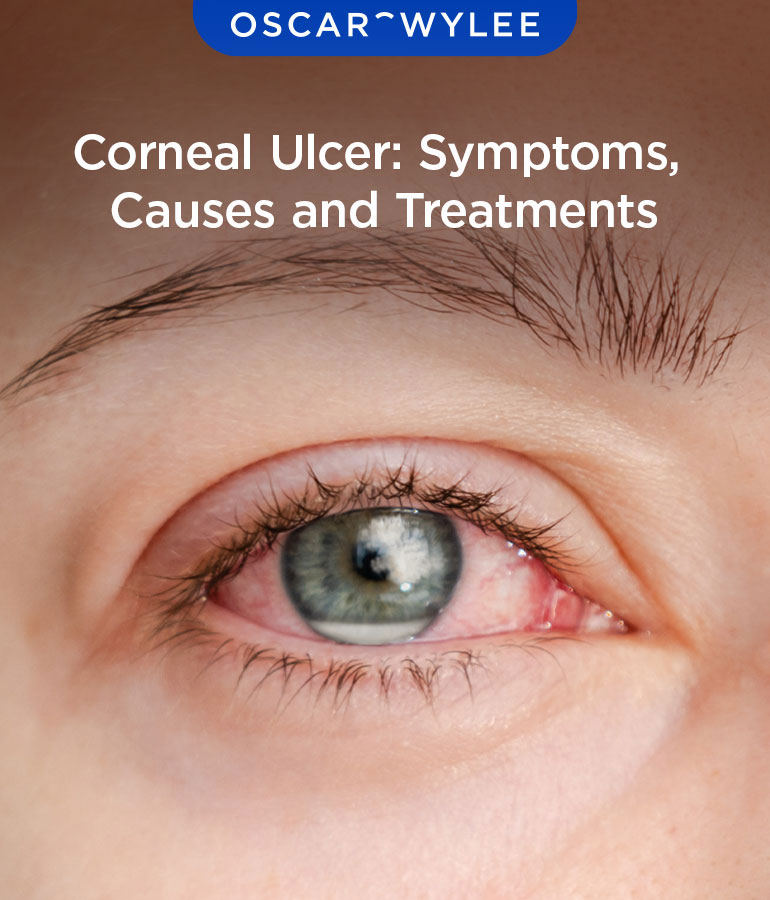 Corneal Ulcer: Symptoms, Causes and Treatments