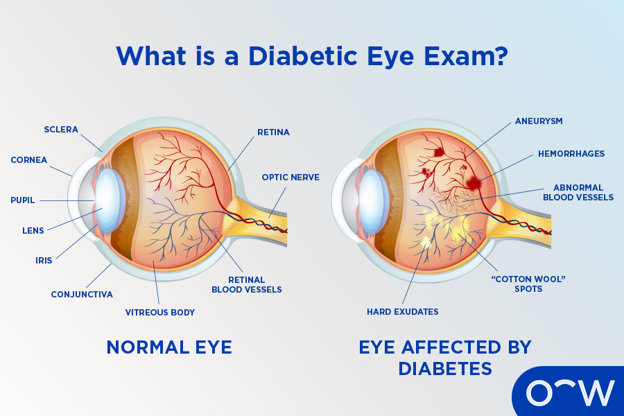 Diabetic Eye Exam: Importance, Purpose, and What to Expect