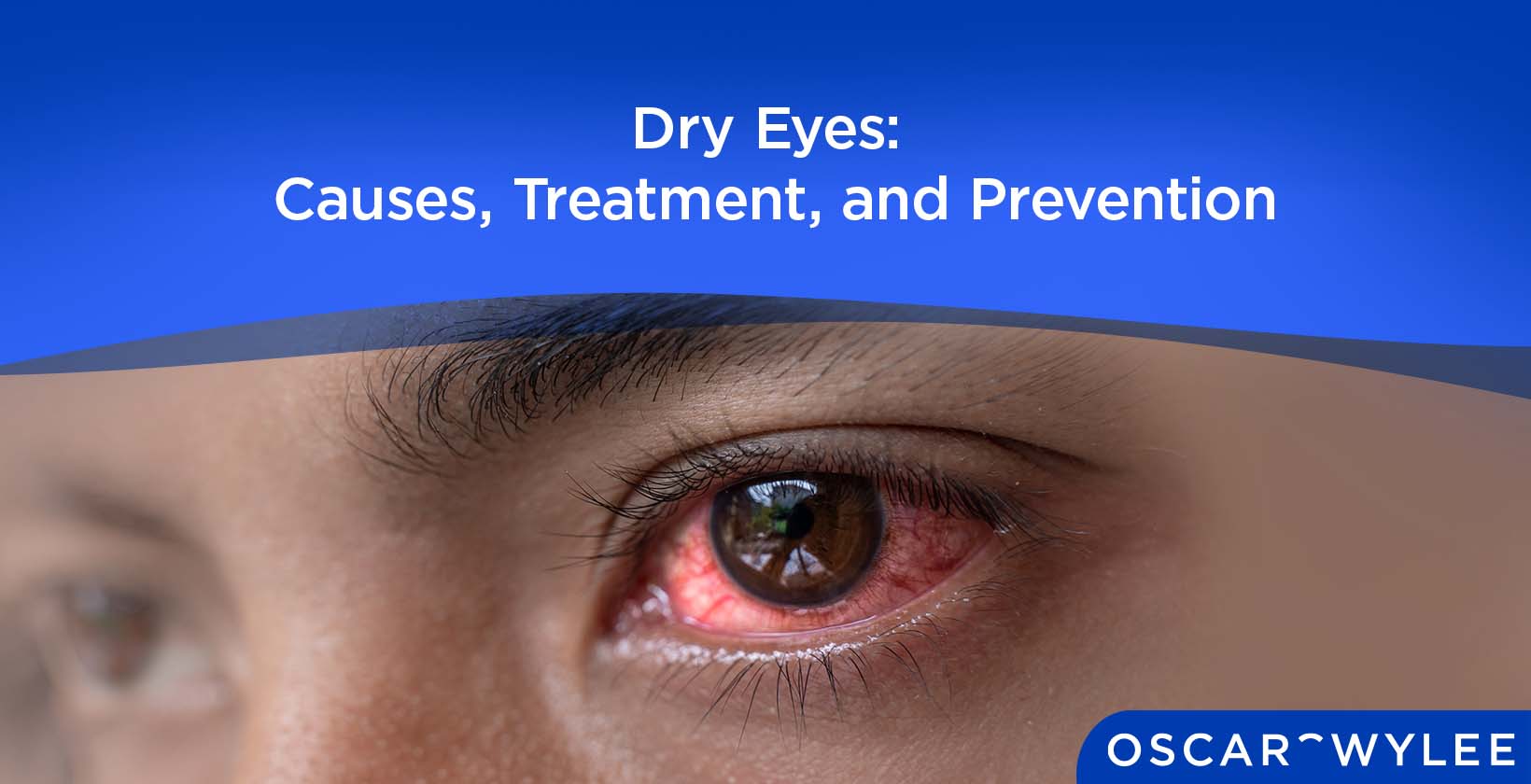 Dry Eyes: Cause, Treatment, and Prevention