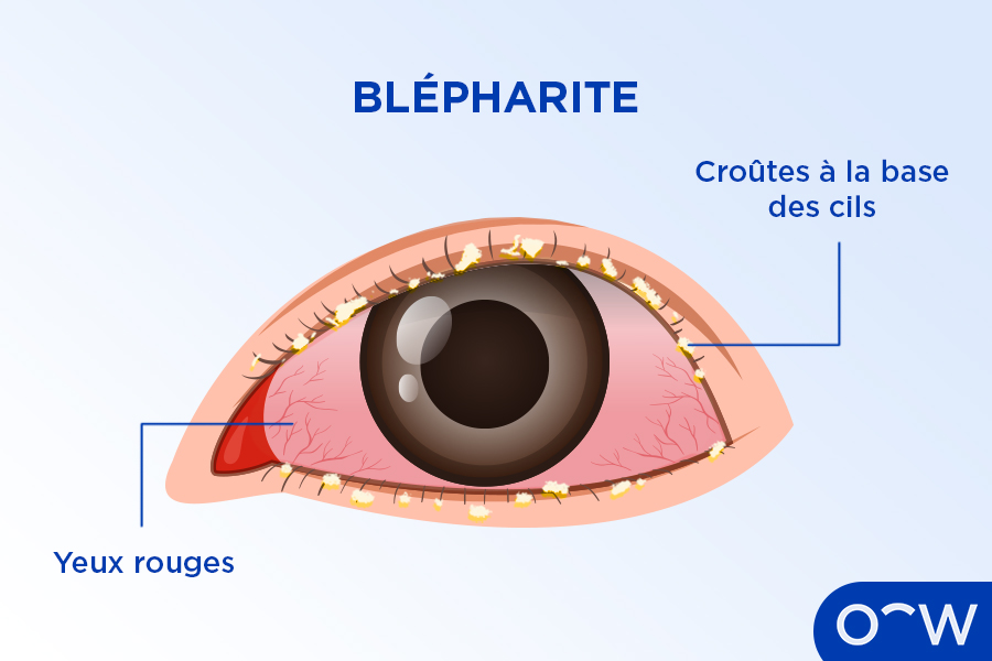 La blépharite : types, causes, symptômes, diagnostic et traitements