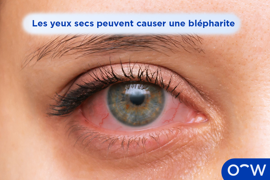 La blépharite : types, causes, symptômes, diagnostic et traitements