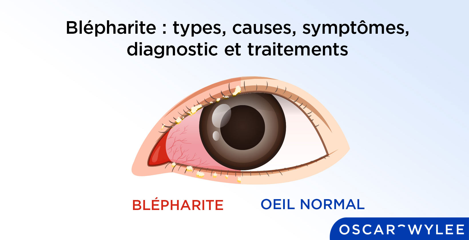 La blépharite : types, causes, symptômes, diagnostic et traitements