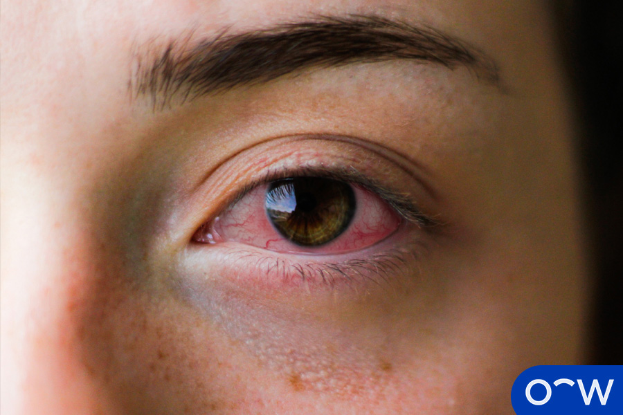 Eye Fatigue: Definition, Causes, Symptoms, and Treatment