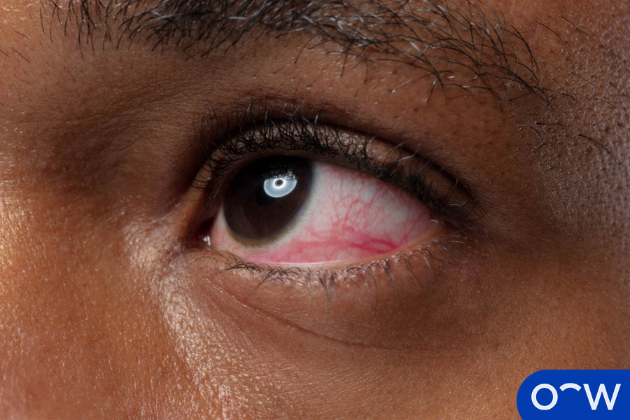 Eye Fatigue: Definition, Causes, Symptoms, and Treatment